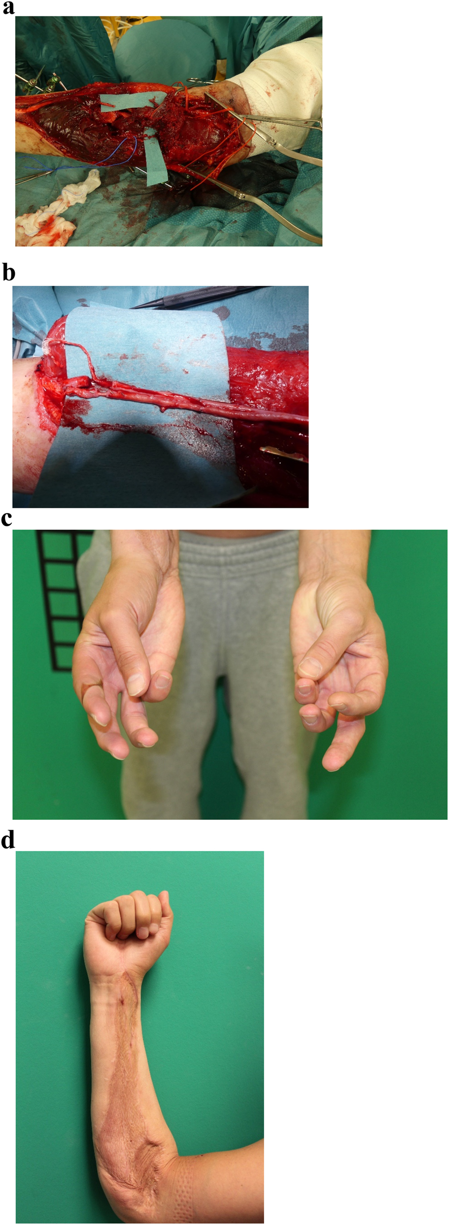 Biological conduits based on spider silk for reconstructi...