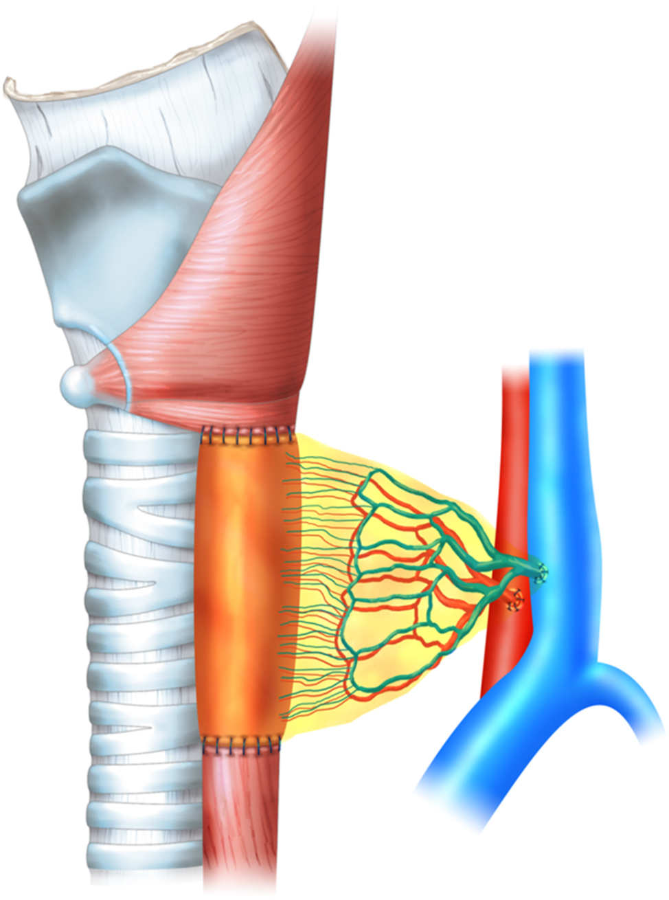 Ileal free flap for hypopharynx reconstruction – case series