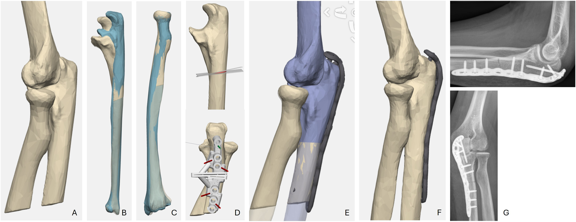 Strategies for surgical reconstruction of complex elbow d...