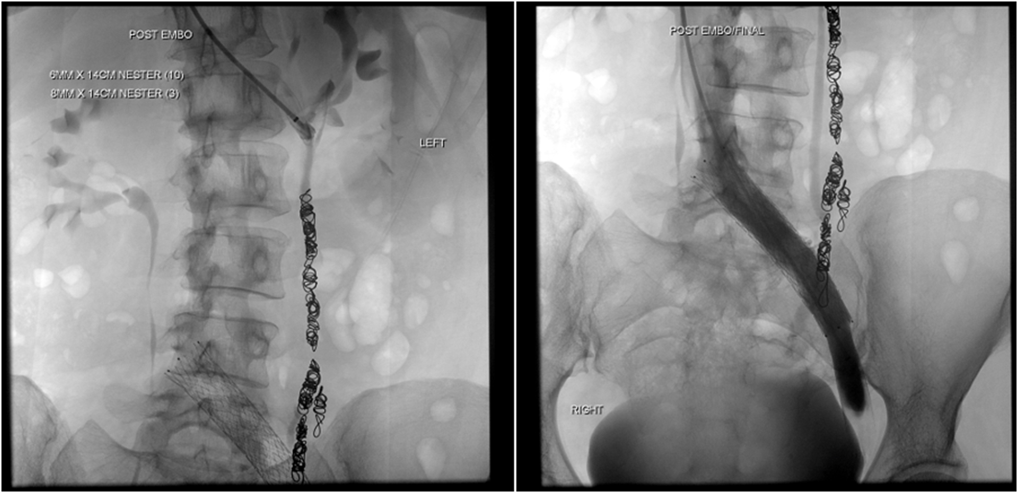 Intraoperative appearance of gonadal vein embolization coil