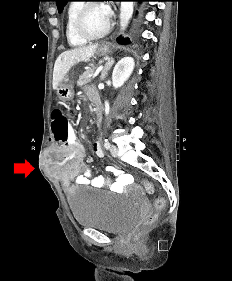 Transverse colon adenocarcinoma with direct cutaneous extension ...