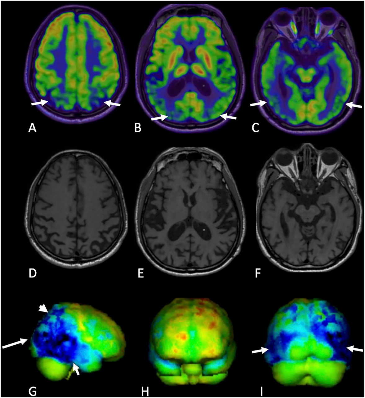 Posterior cortical atrophy