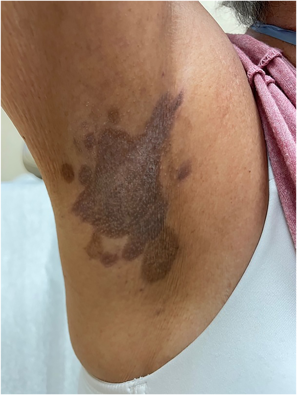 Lichen planus pigmentosus inversus: a rare clinical variant