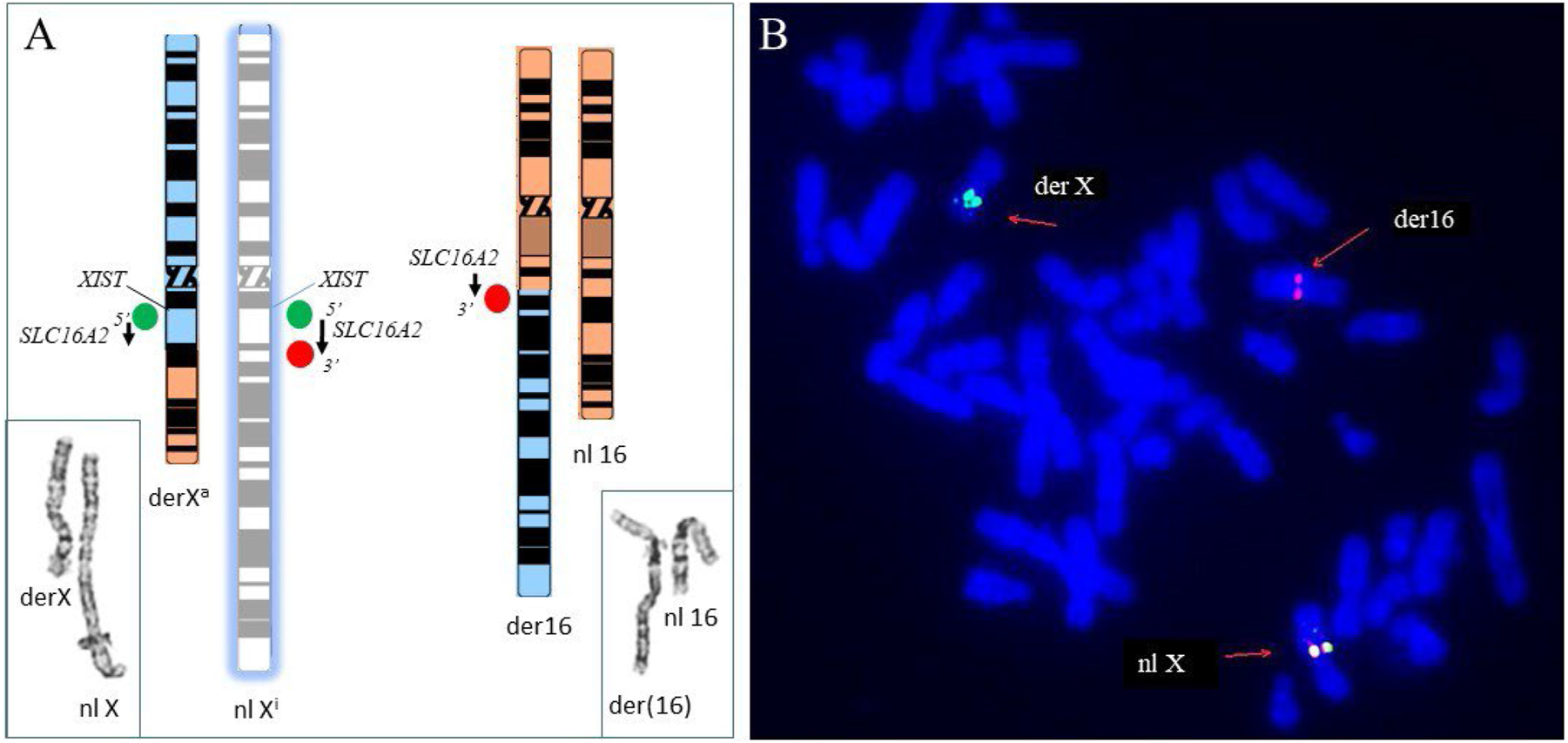 Late diagnosis of the X-linked MCT8 deficiency (Allan–Herndon–Dudley ...