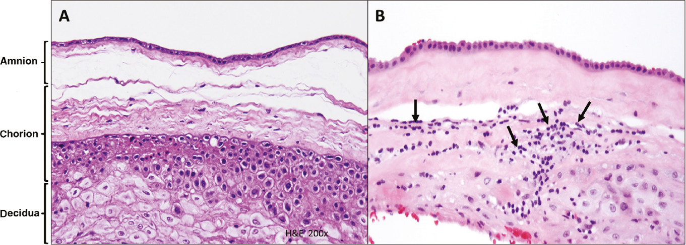 Fetal death: an extreme manifestation of maternal anti-fetal rejection