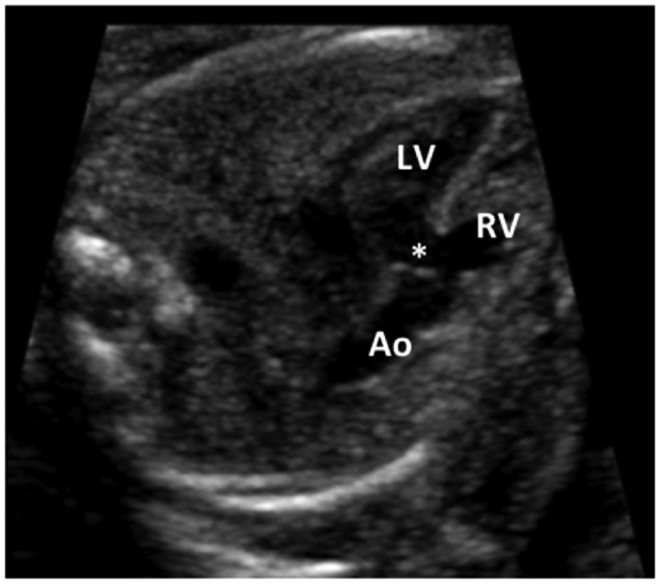 Prenatal diagnosis, associated findings and postnatal outcome of ...
