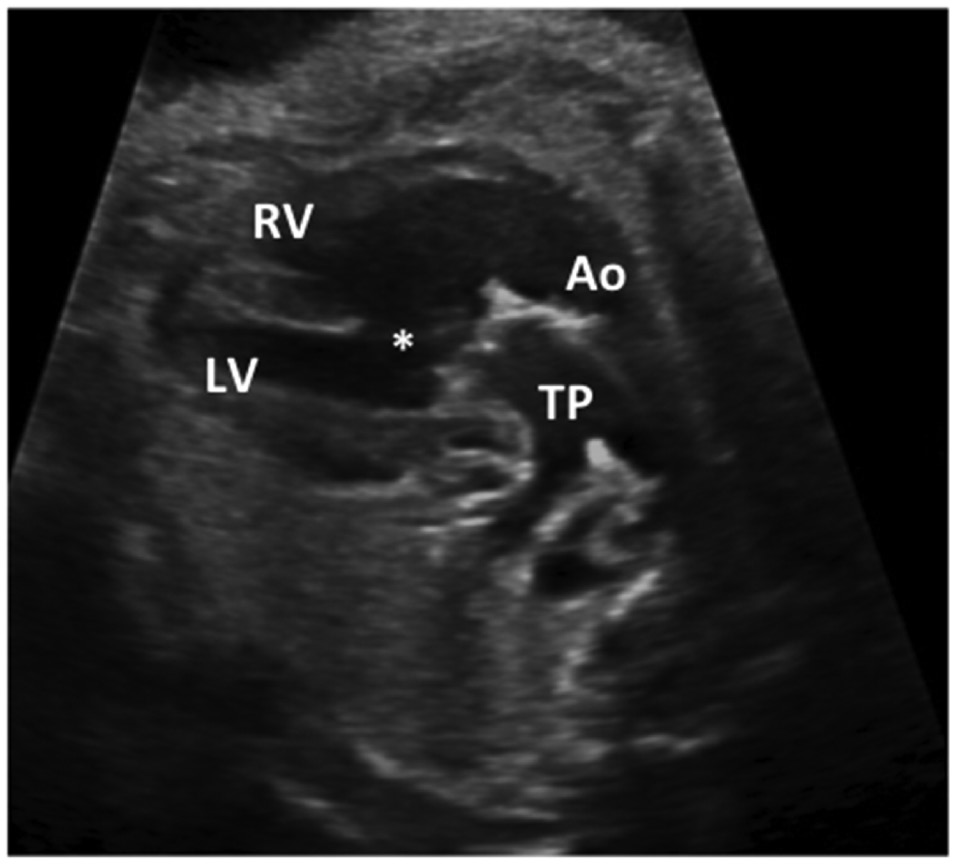 Prenatal diagnosis, associated findings and postnatal outcome of ...