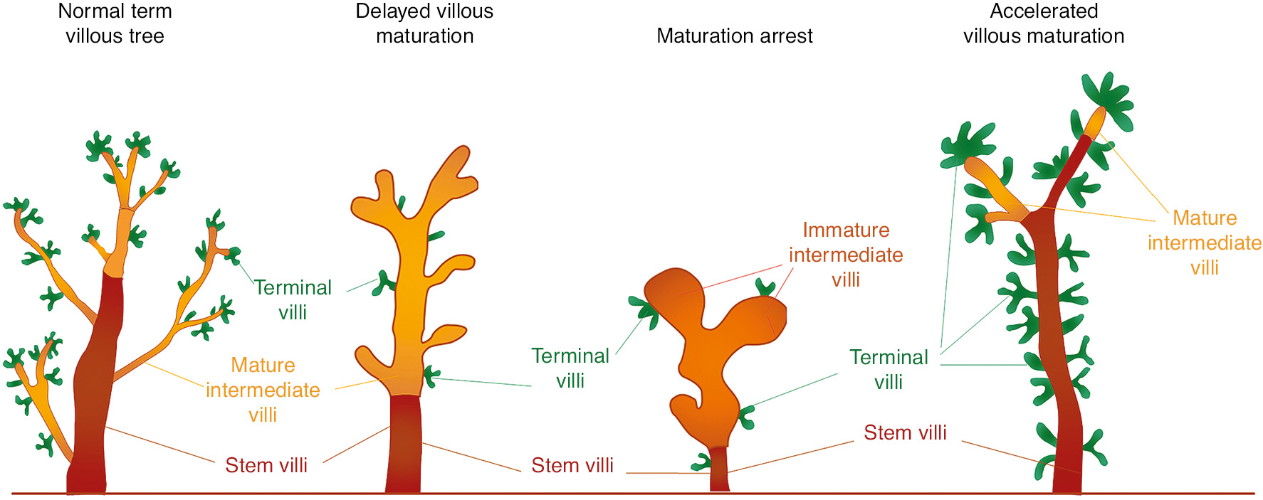 Disorders of placental villous maturation in fetal death