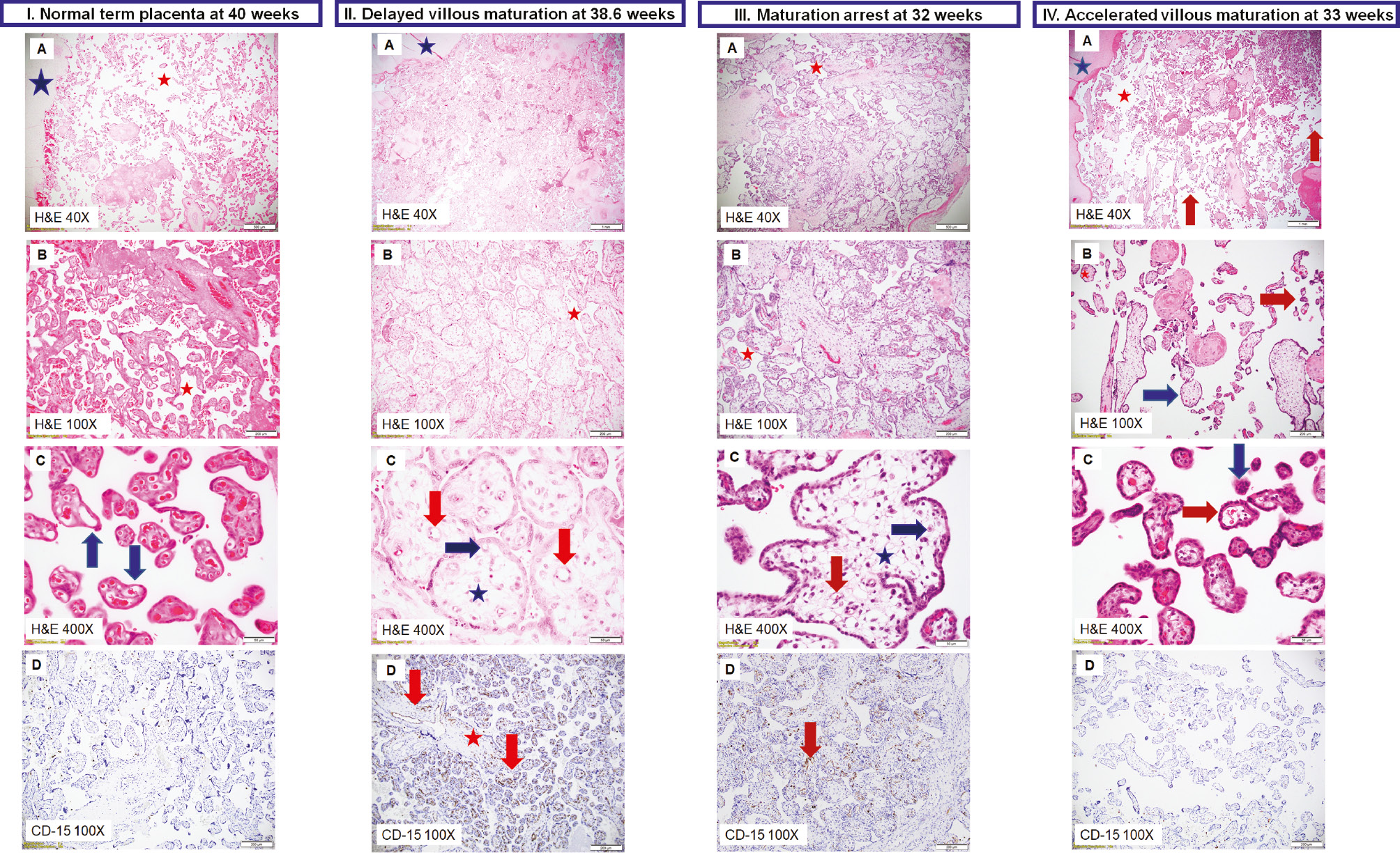 Disorders of placental villous maturation in fetal death