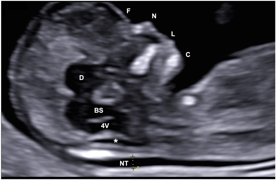 First trimester examination of fetal anatomy: clinical practice ...