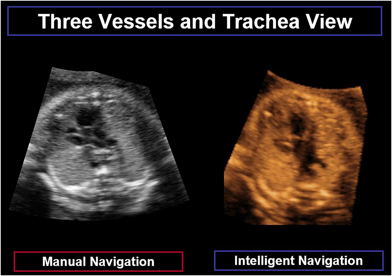 Fetal intelligent navigation echocardiography (FINE) has superior ...