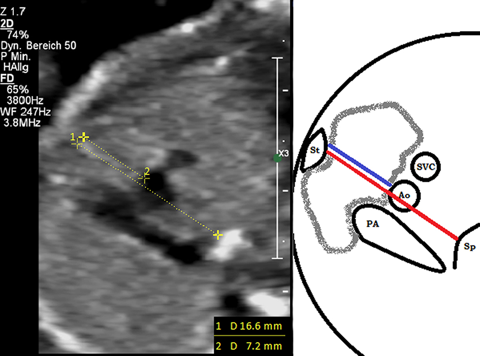 Comparative sonographic measurement of the fetal thymus size in ...