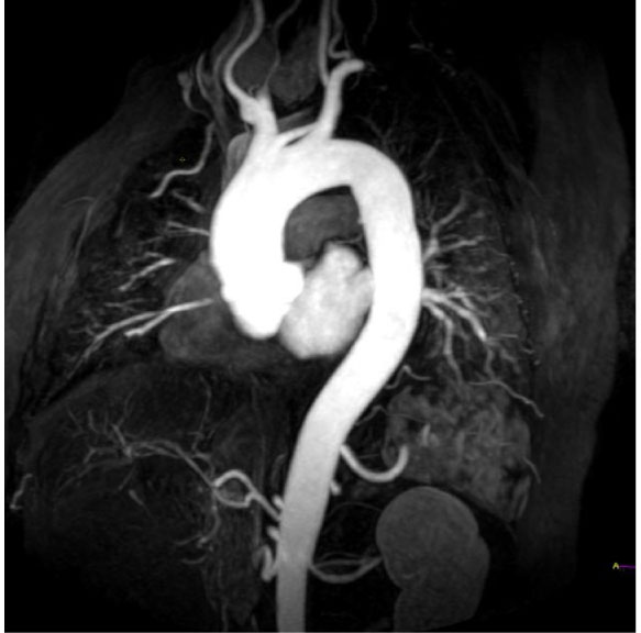 CT and MR imaging of the thoracic aorta