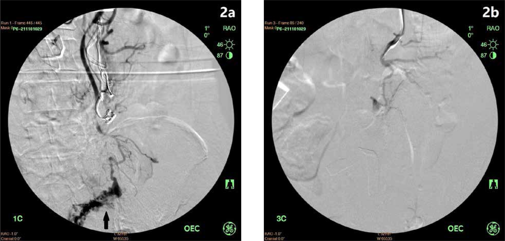 Foam sclerotherapy during shunt surgery for portal hypert...