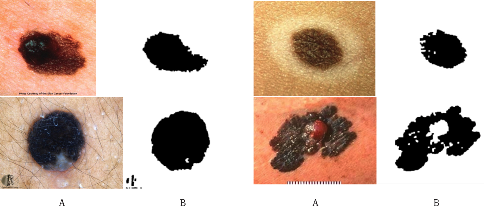 A hybrid neural network – world cup optimization algorithm for melanoma detection