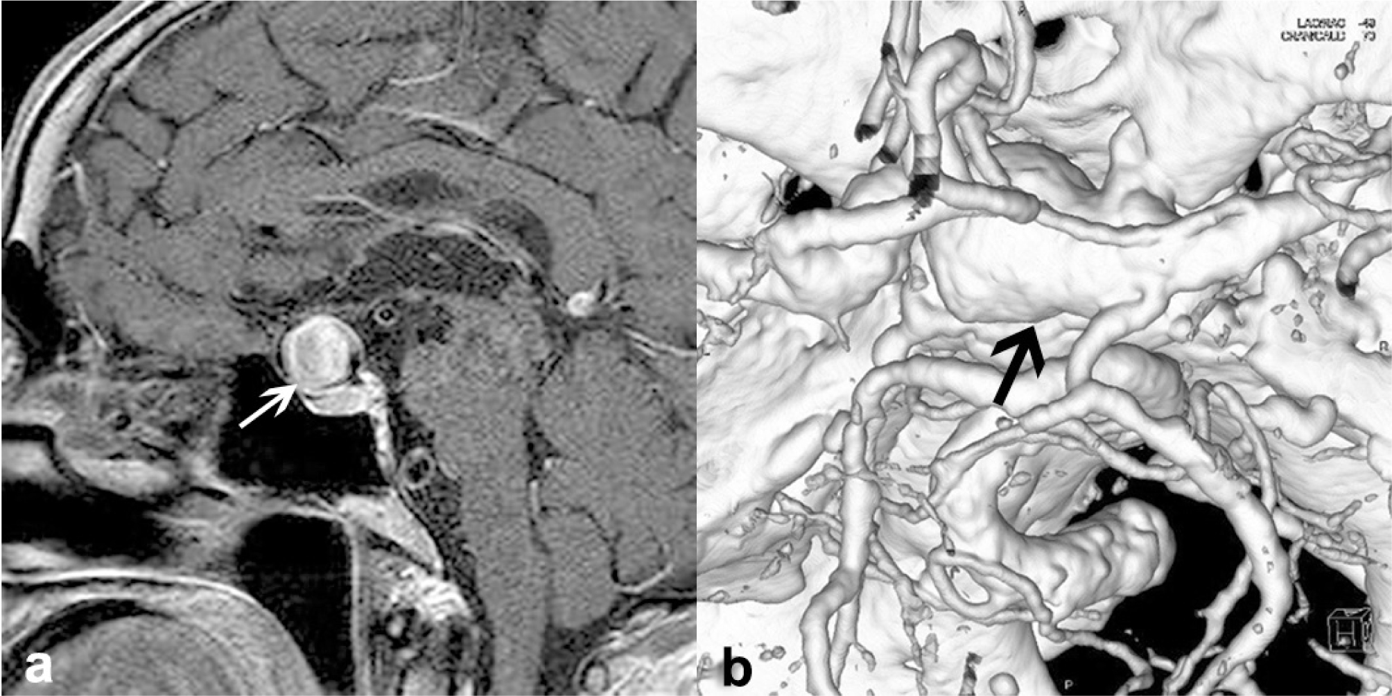 Pituitary dysfunction from an unruptured ophthalmic internal carotid ...