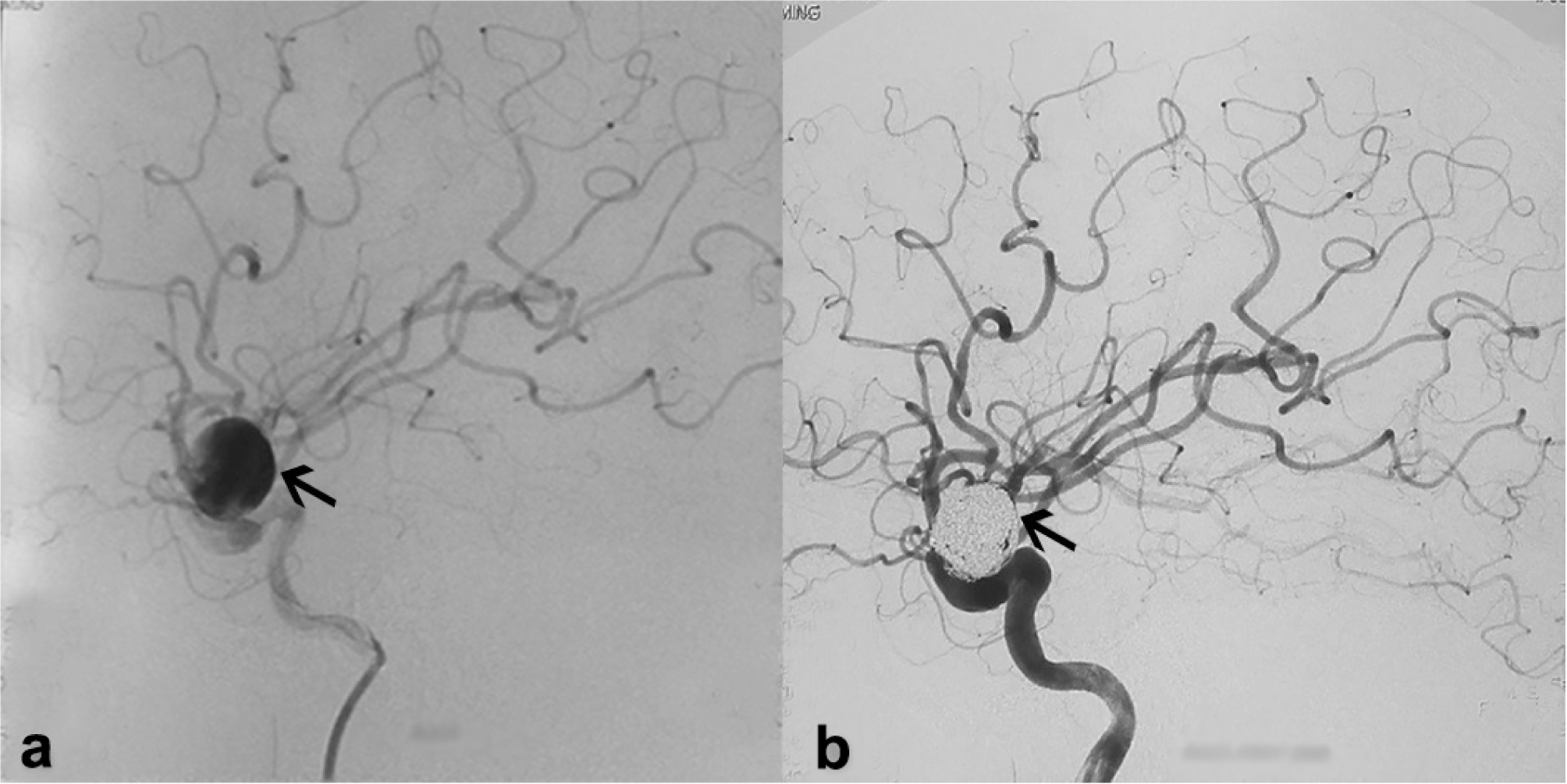 Pituitary dysfunction from an unruptured ophthalmic internal carotid ...
