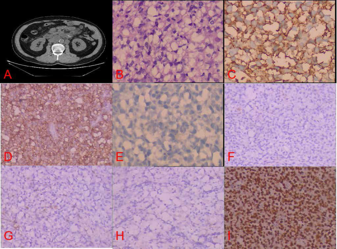 Signet ring B cell lymphoma: A potential diagnostic pitfall