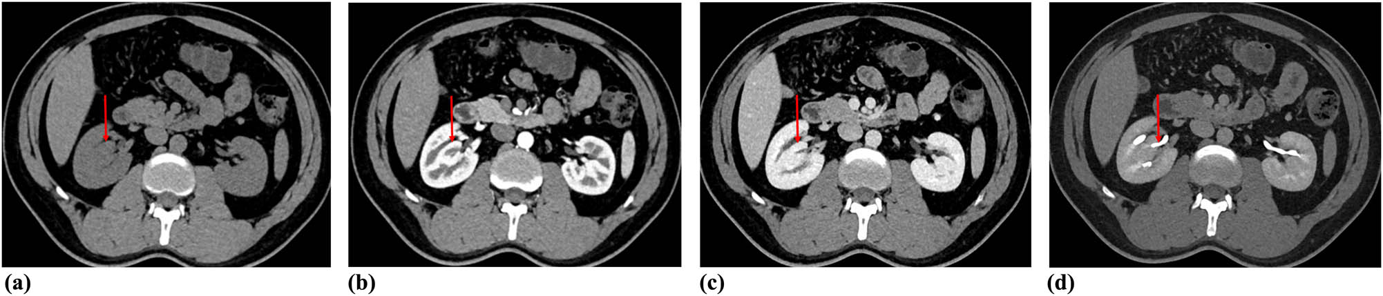 CTU findings of duplex kidney in kidney: A rare duplicated renal ...