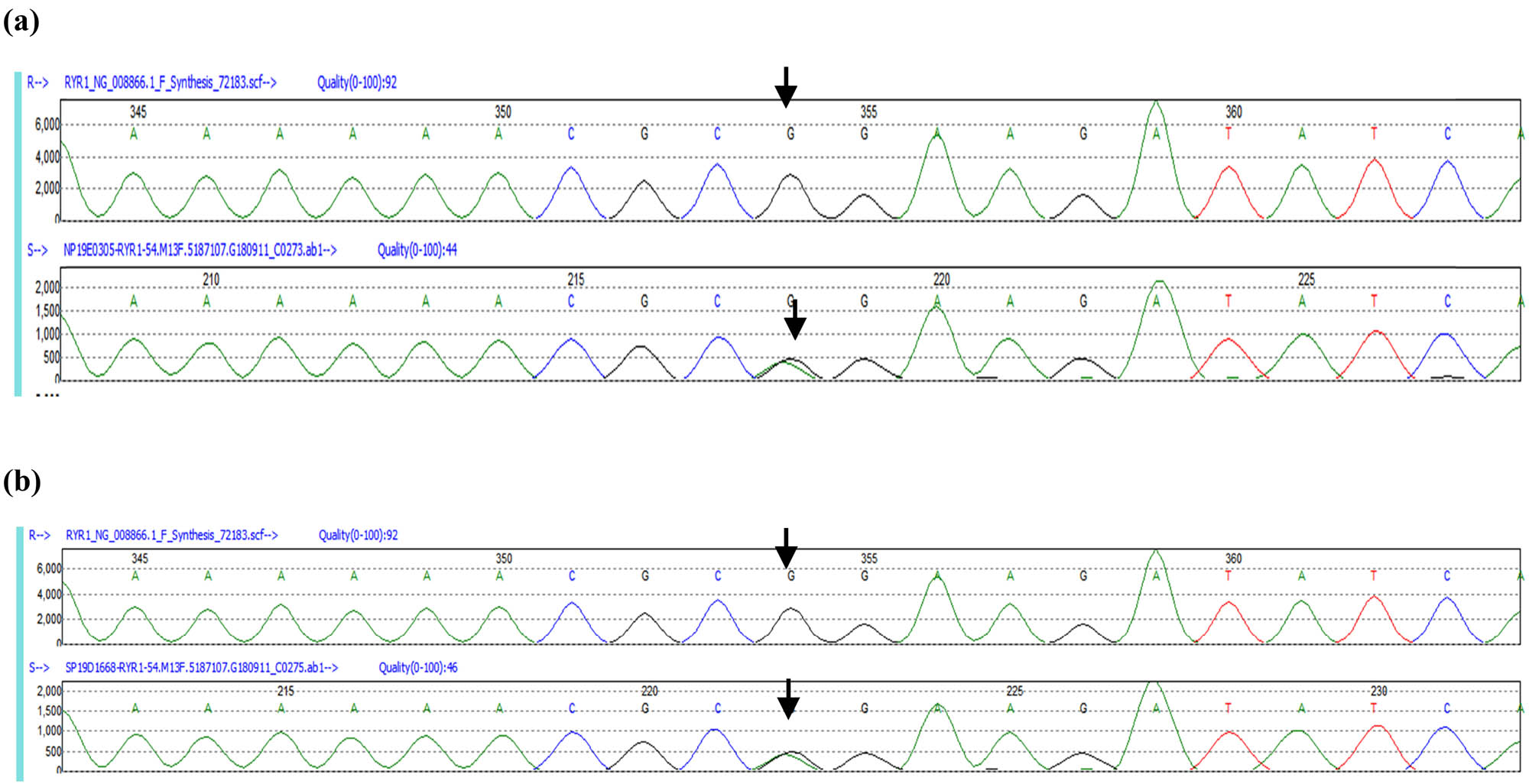 Atypical symptoms of malignant hyperthermia: A rare causative mutation ...