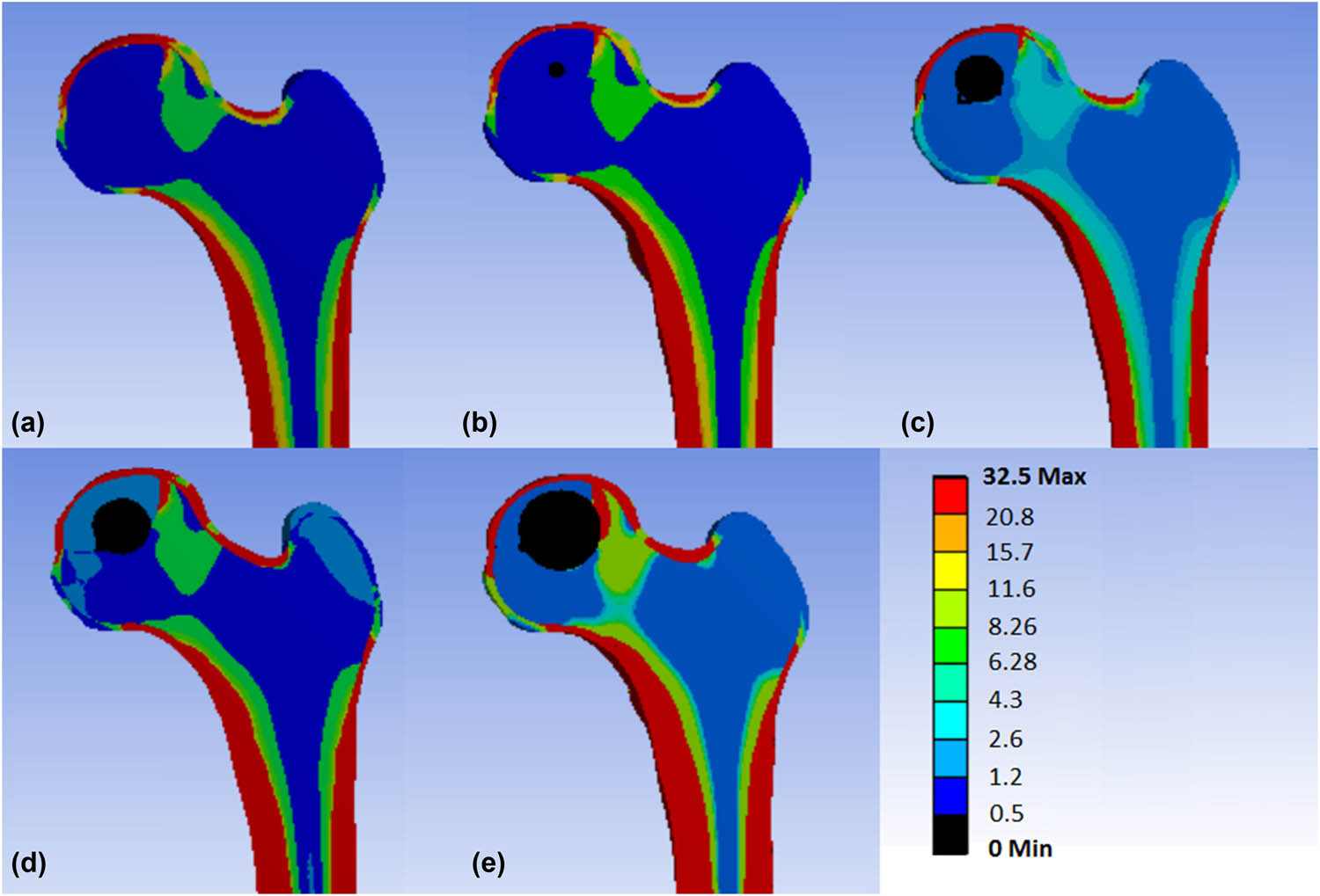Effect of femoral head necrosis cystic area on femoral head collapse and stress distribution in ...