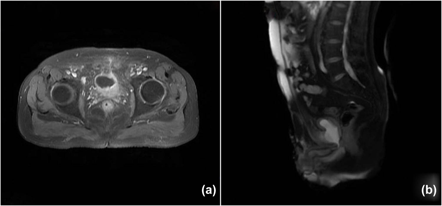 Simultaneous treatment of a pubovesical fistula and lymph node ...