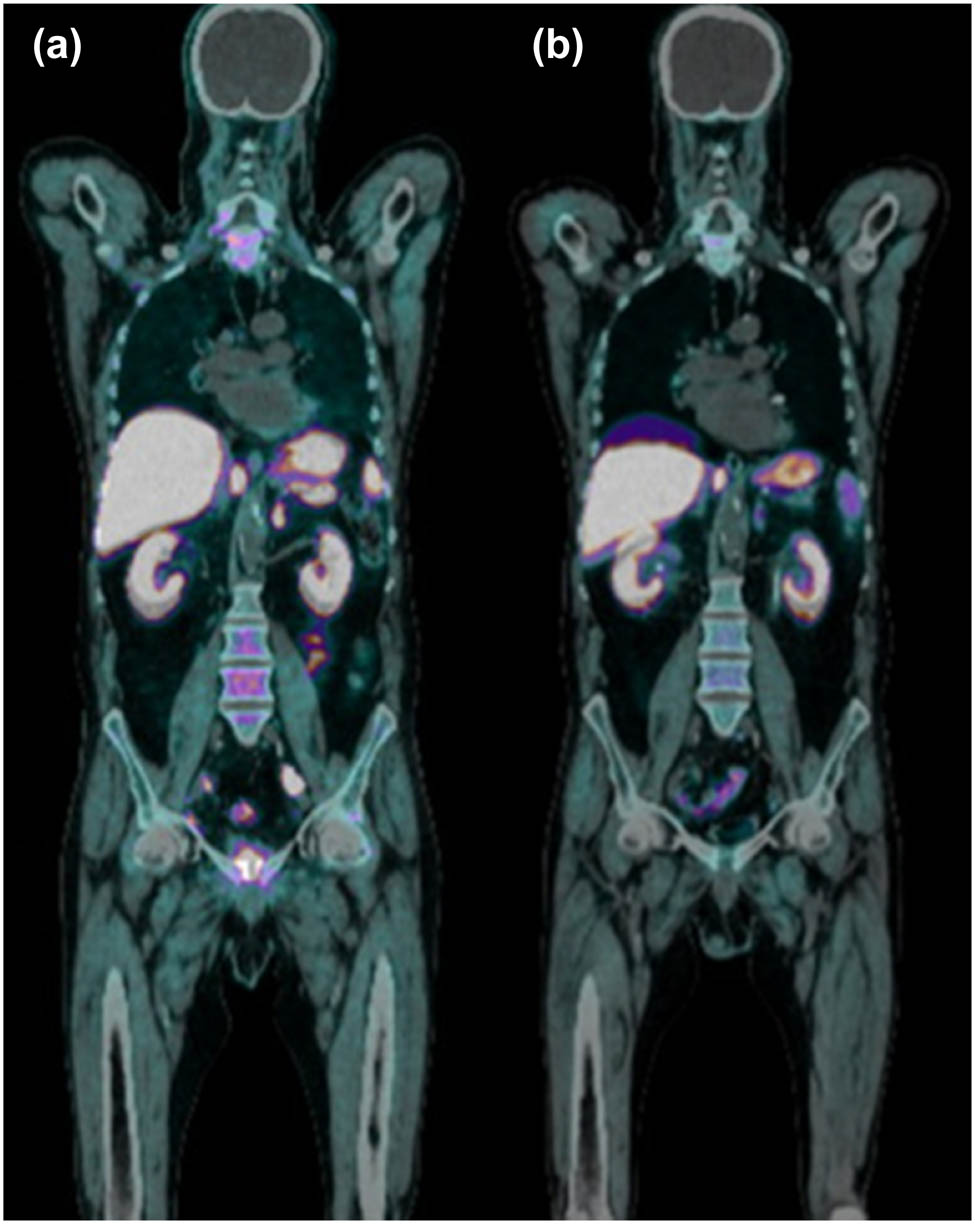 Simultaneous treatment of a pubovesical fistula and lymph node ...