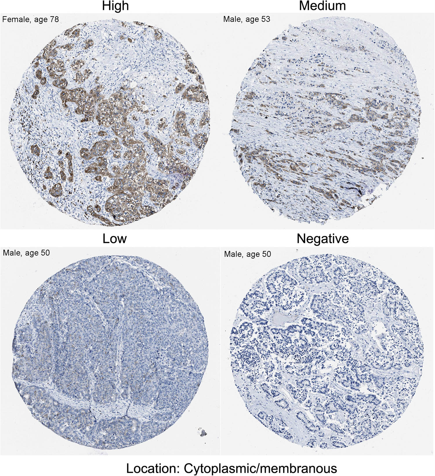 Integrated bioinformatics analysis shows integrin alpha 3 is a ...