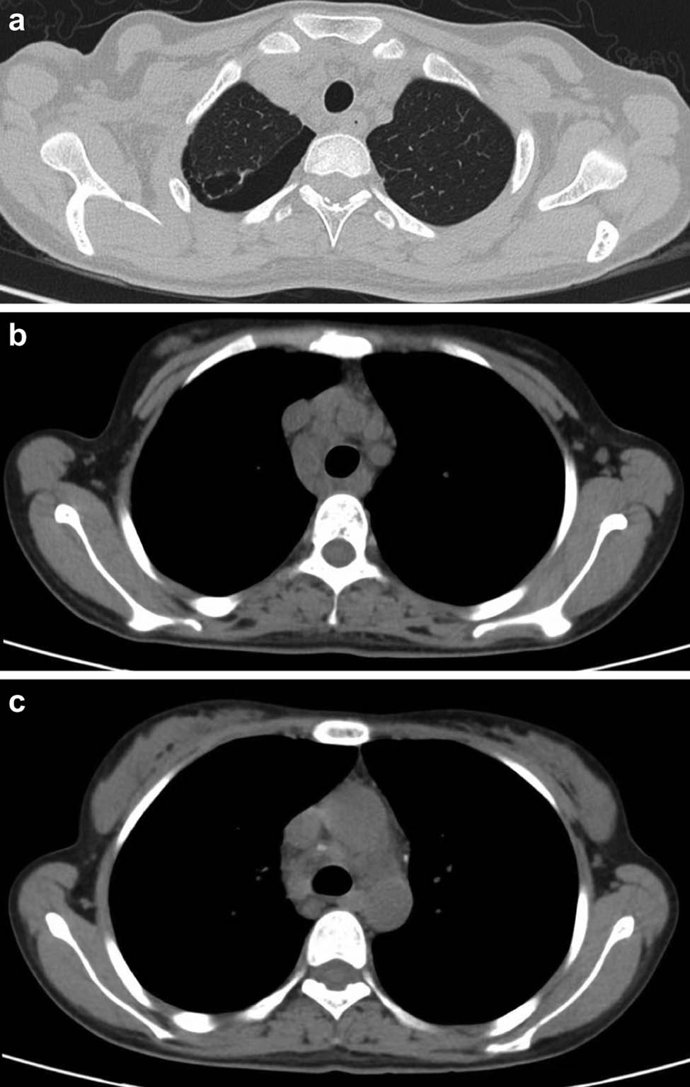 Mycobacterium xenopi infection of the kidney and lymph nodes: A case report