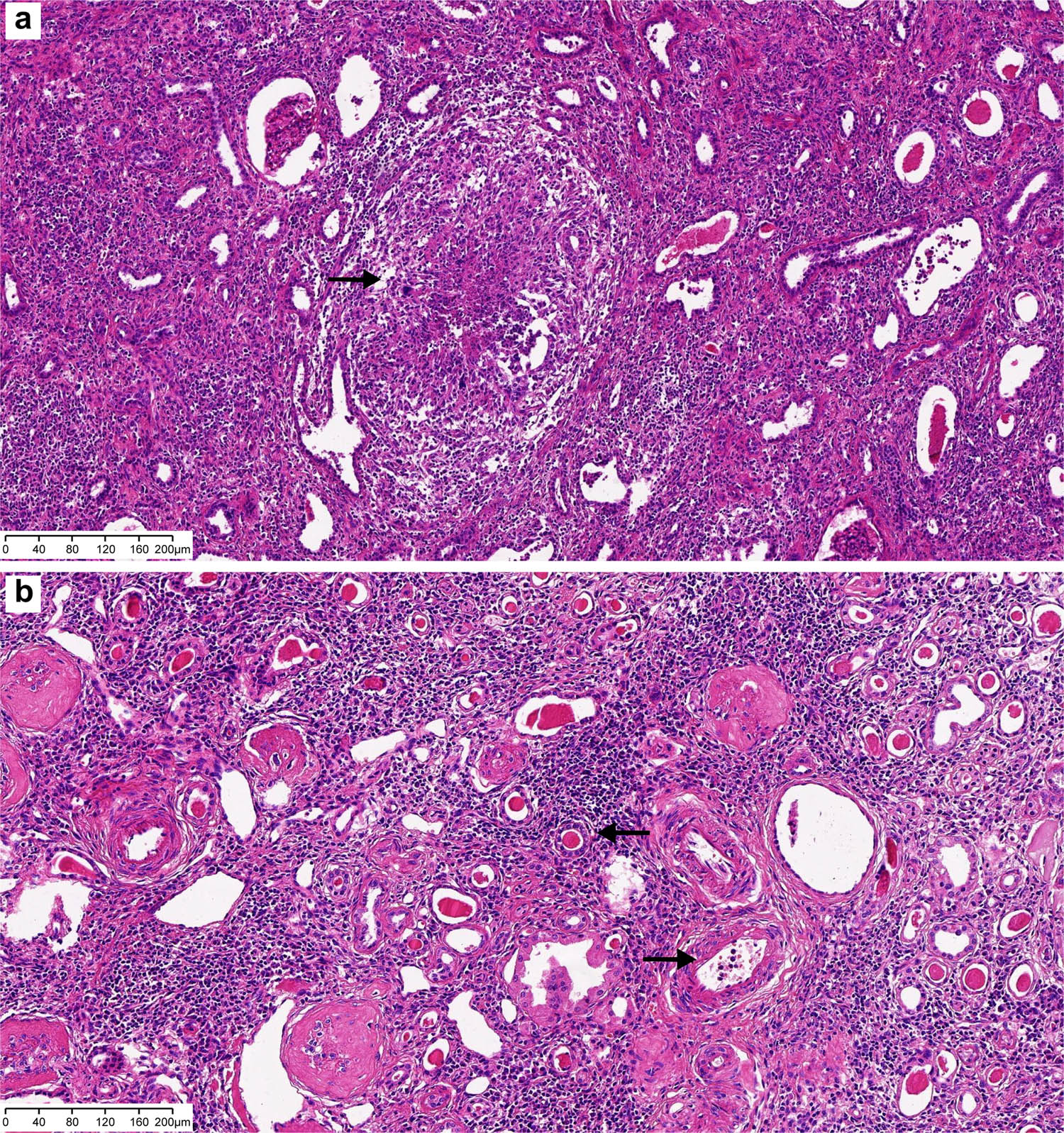 Mycobacterium xenopi infection of the kidney and lymph nodes: A case report