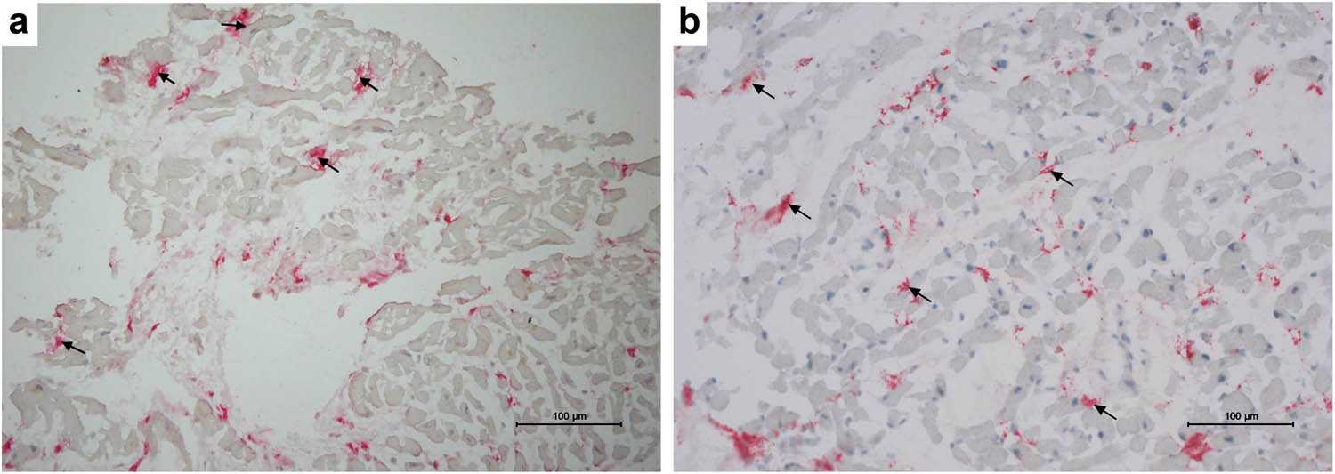 Adhered macrophages as an additional marker of cardiomyocyte injury in ...