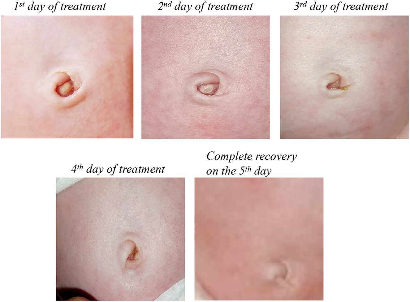 Observational retrospective study on neonatal umbilical c...