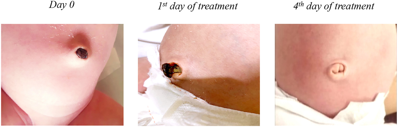 Observational retrospective study on neonatal umbilical c...