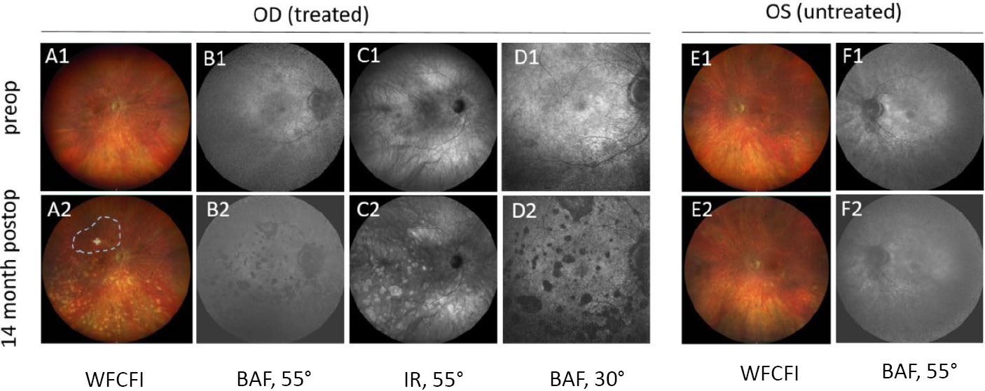Long-term experience with gene augmentation therapy in patients with inherited retinal disease ...