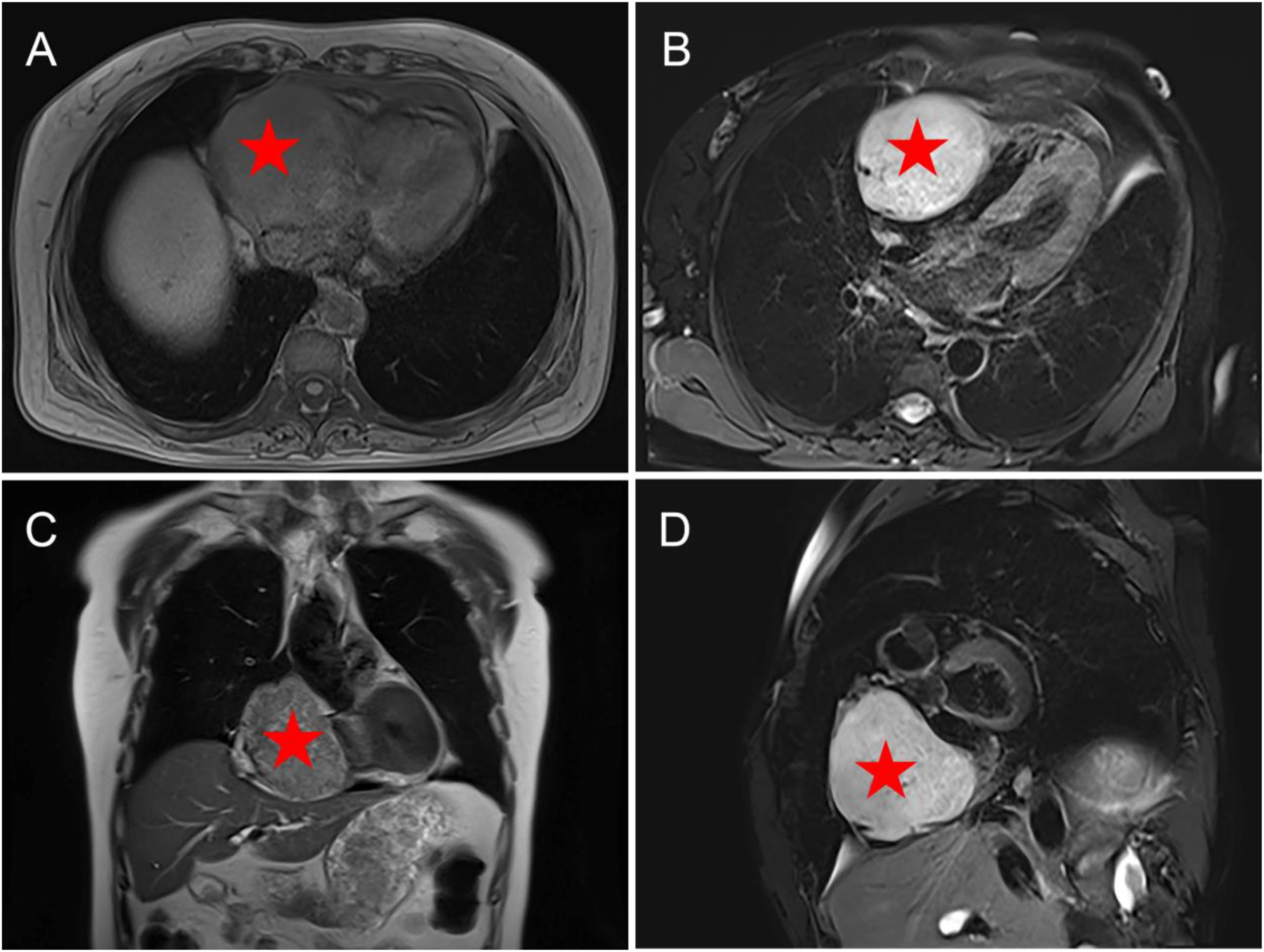 Intrapericardial nonfunctional paraganglioma: a case report and ...
