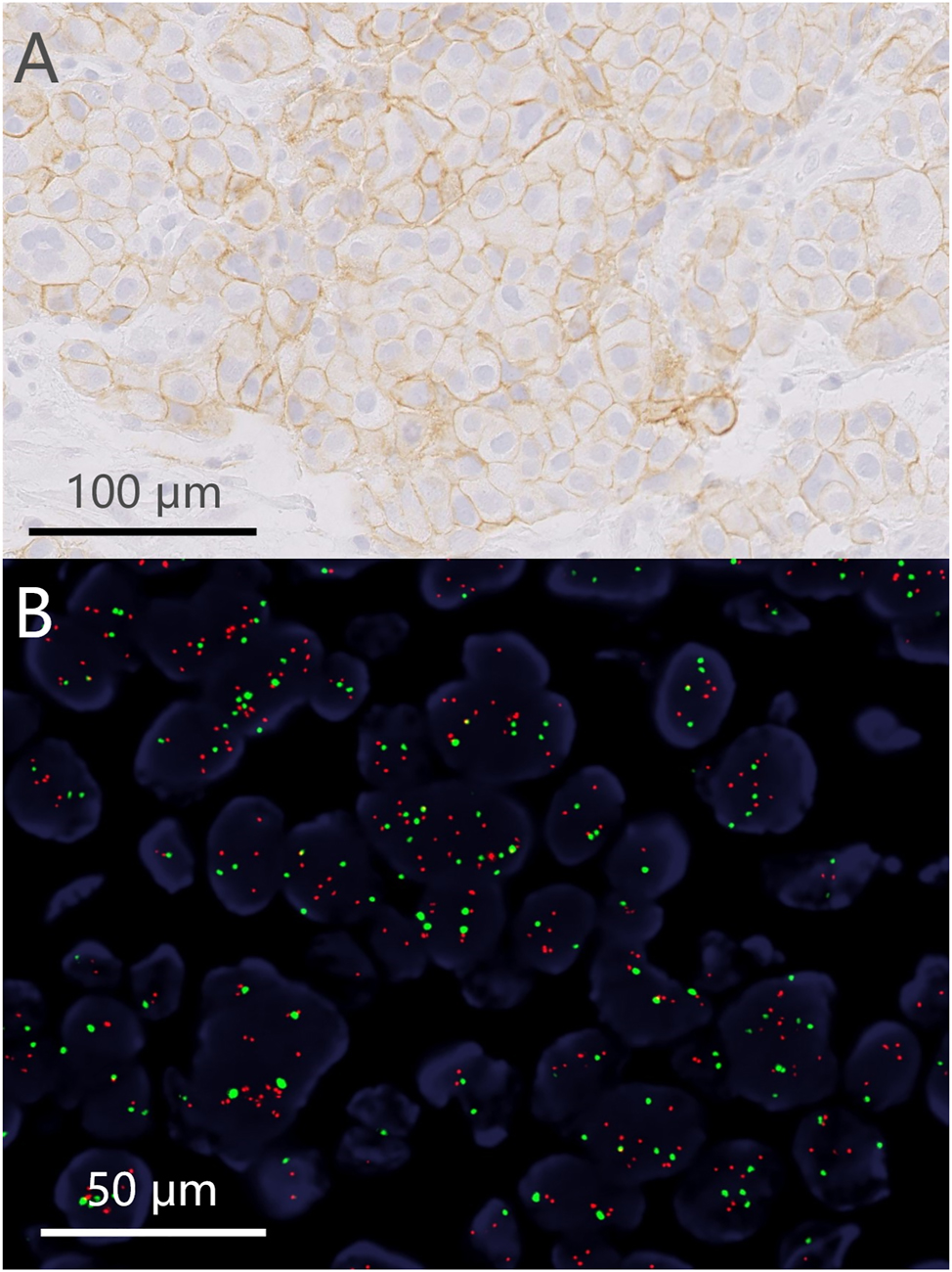 Evaluation of HER2 immunohistochemistry-positive and immu...