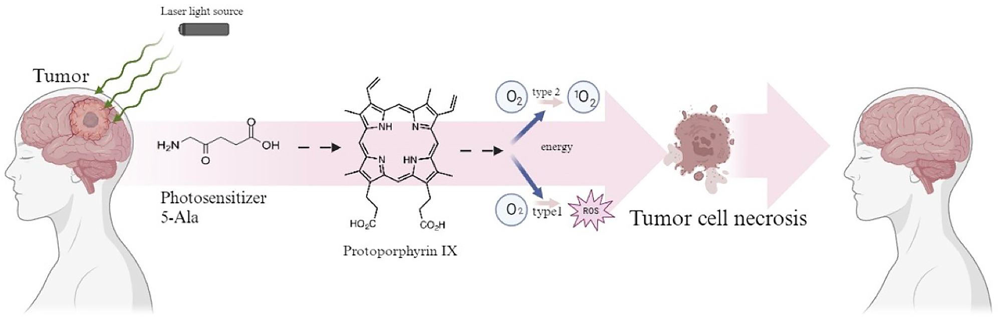 The assessment of 5-aminolevulinic acid photodynamic therapy in ...