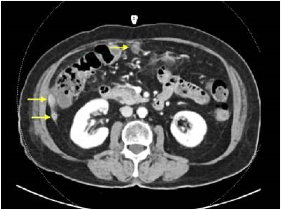 14th PSOGI-ISSPP International congress on Peritoneal Surface Malignancies*