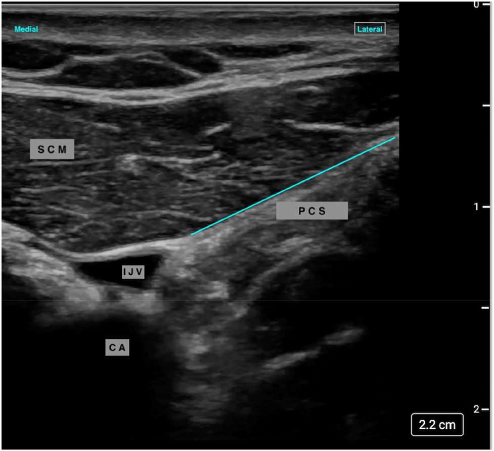 Intermediate cervical plexus block in the management of treatment ...