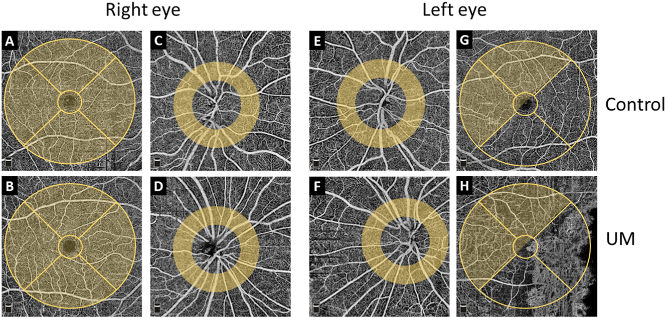 Acute effects of high-intensity interval training on micr...