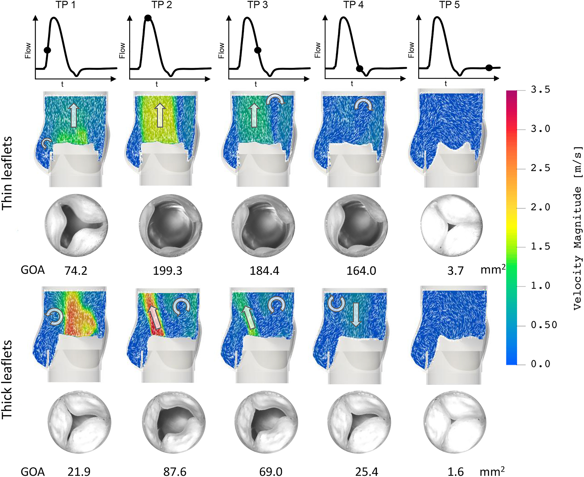 Analysis on the effects of hypo-attenuated leaflet thicke...