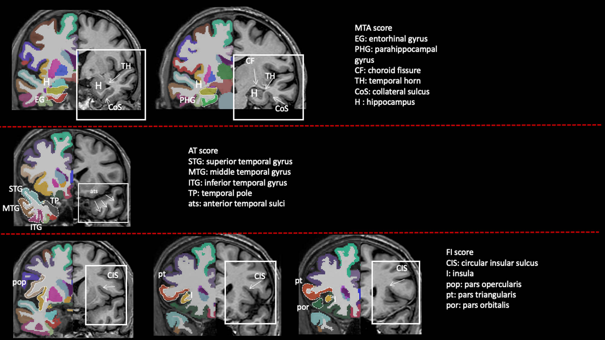 Brain atrophy pattern in patients with mild cognitive impairment: MRI study