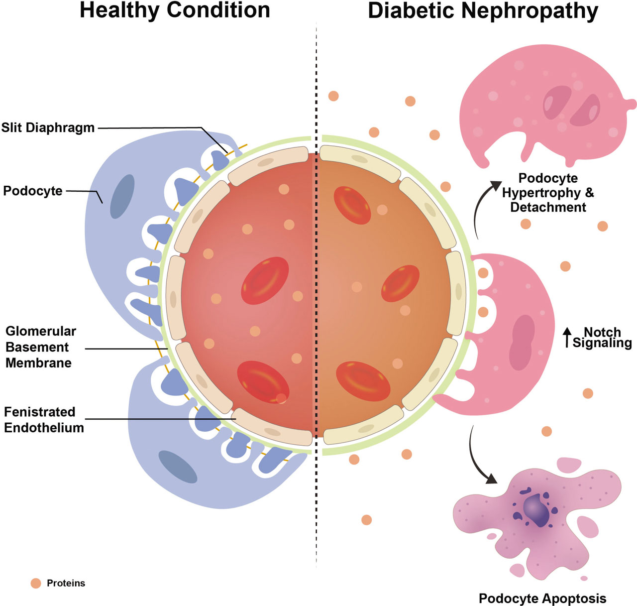 Podocyte developmental pathways in diabetic nephropathy: A spotlight on ...