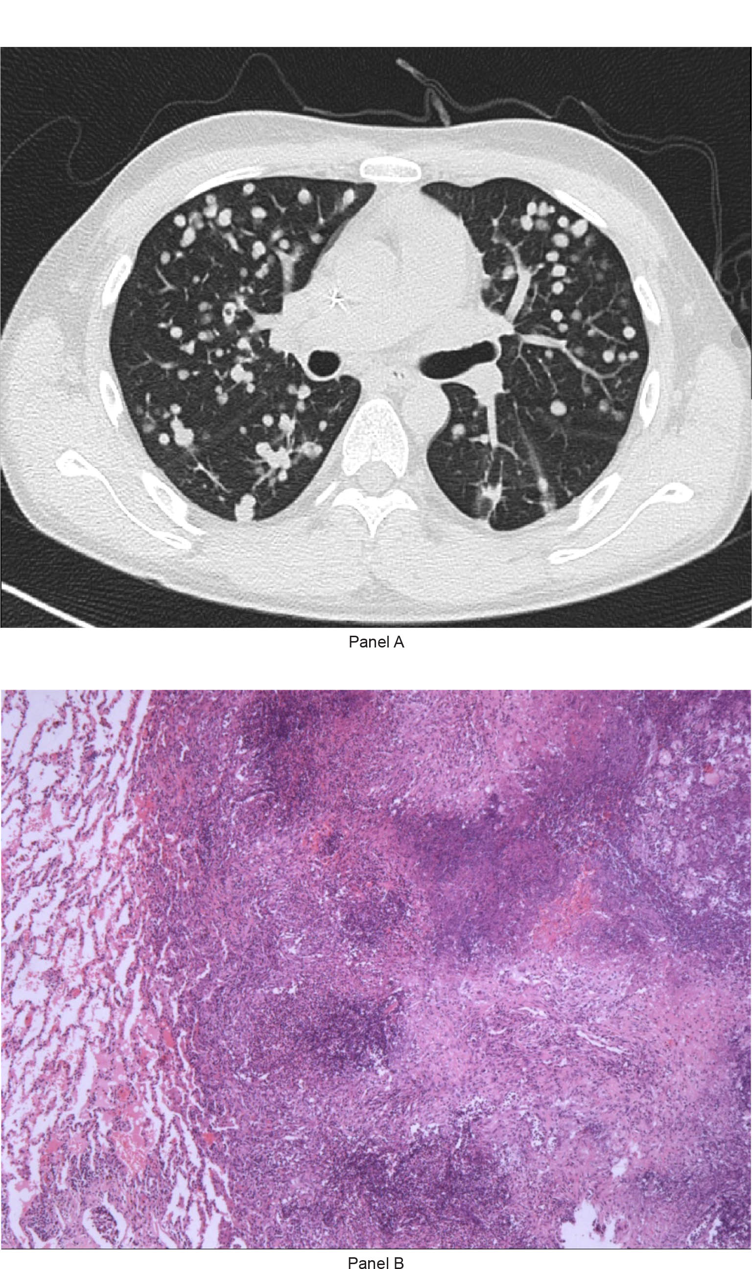 “Tree in Bud” in the Chest CT of a Patient with Granulomatosis Polyangiitis