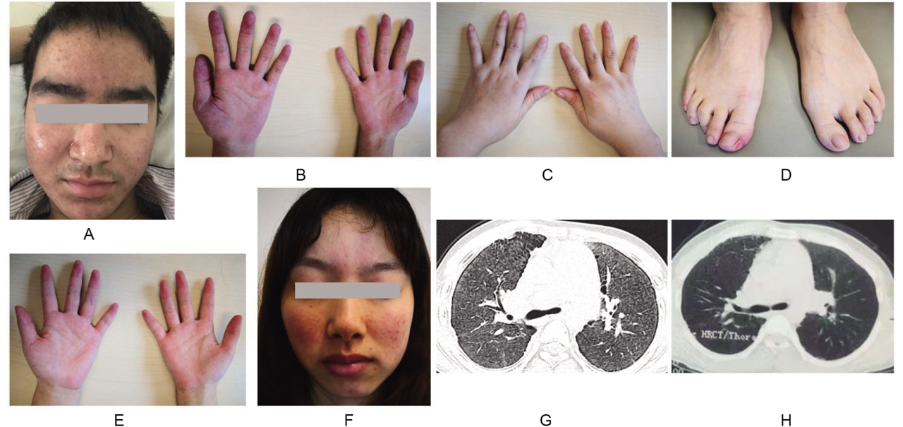 A 16-year-old boy with arthritis, rash, and hemoptysis: Beyond ...