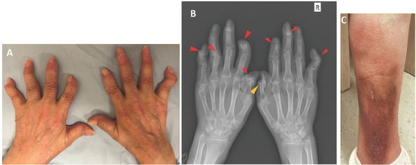 Lupus hands mimicking psoriatic arthritis