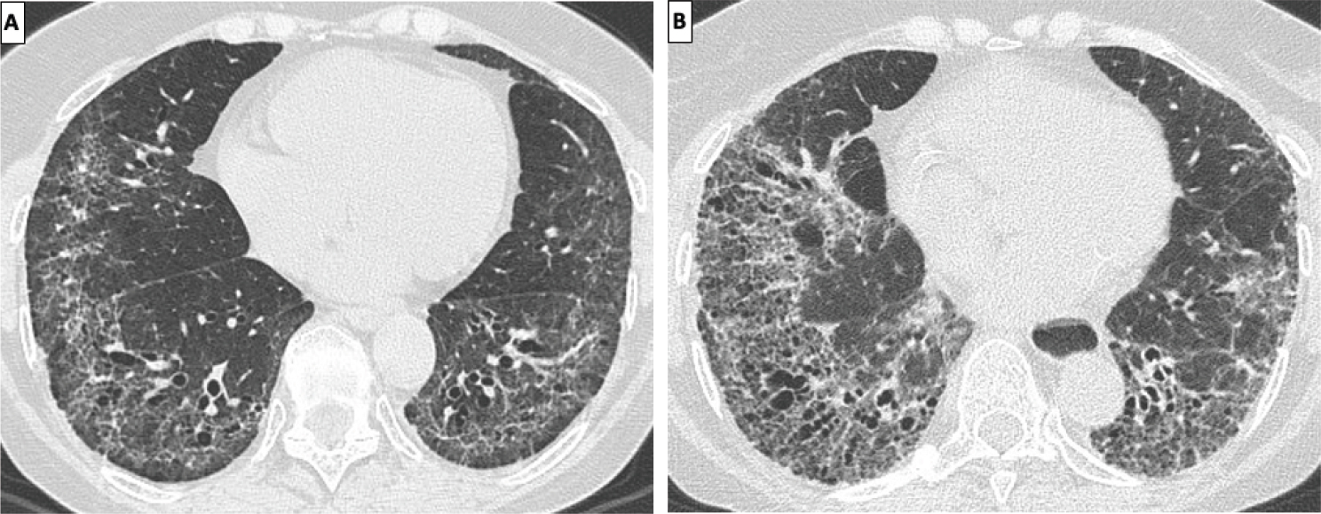High resolution computed tomography in systemic sclerosis: From ...