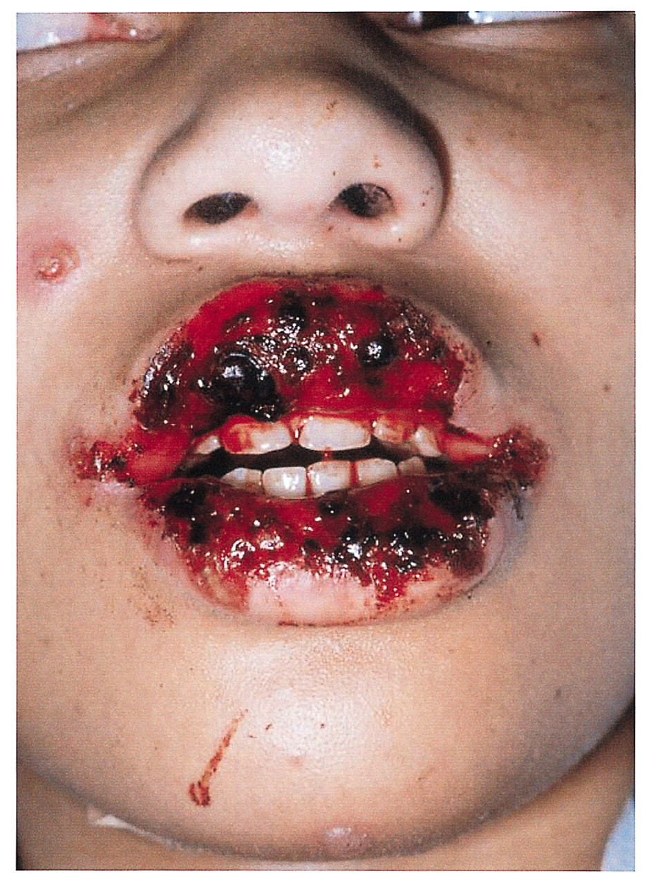 Early Diagnosis Is Key in Vancomycin-Induced Linear IgA Bullous ...