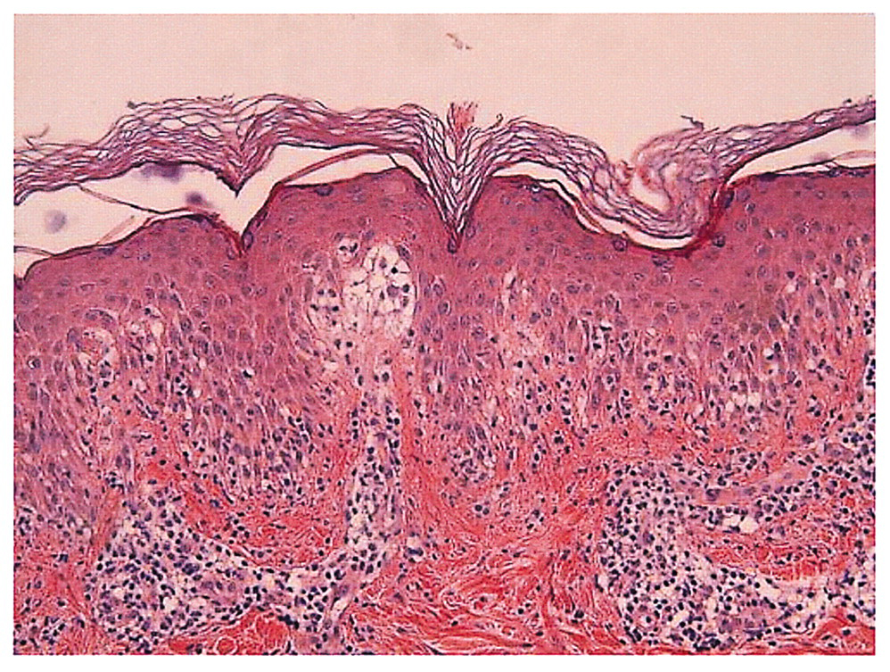 Early Diagnosis Is Key in Vancomycin-Induced Linear IgA Bullous ...