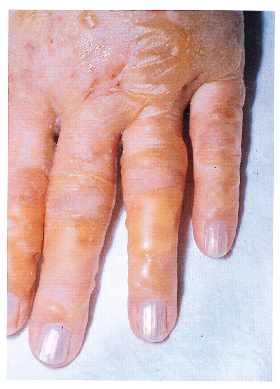 Early Diagnosis Is Key in Vancomycin-Induced Linear IgA Bullous ...